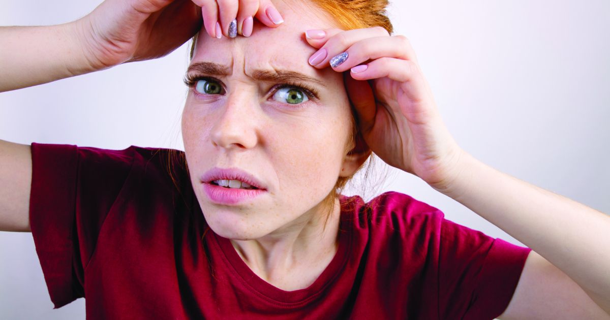 Akne v puberteti: žebelj v mladostnikovo samozavest - Svet24.si