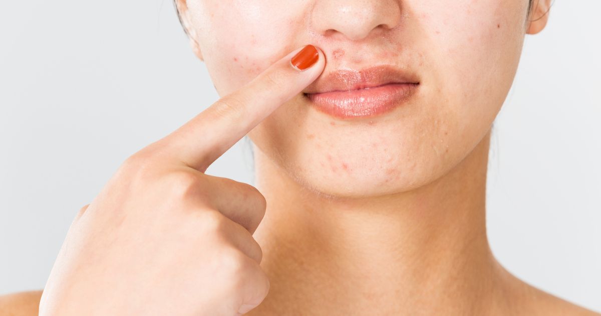 Kaj razkriva pojav mozoljev - Svet24.si