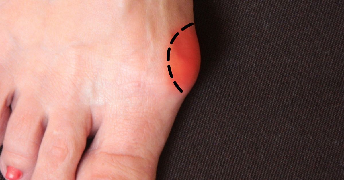 Hallux valgus je boleča deformacija prve stopalne kosti - Svet24.si