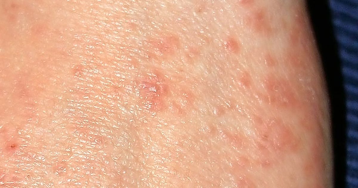 Na Gorenjskem so se v šolah pojavile garje - Svet24.si