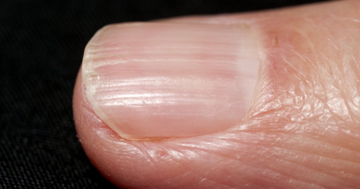 Brazdasti nohti - bi vas moralo skrbeti? - Svet24.si